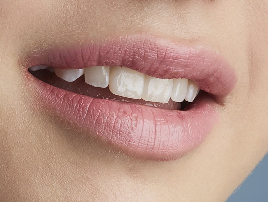 More Kissability With Restylane Kysse Lip Fillers For Full Lips